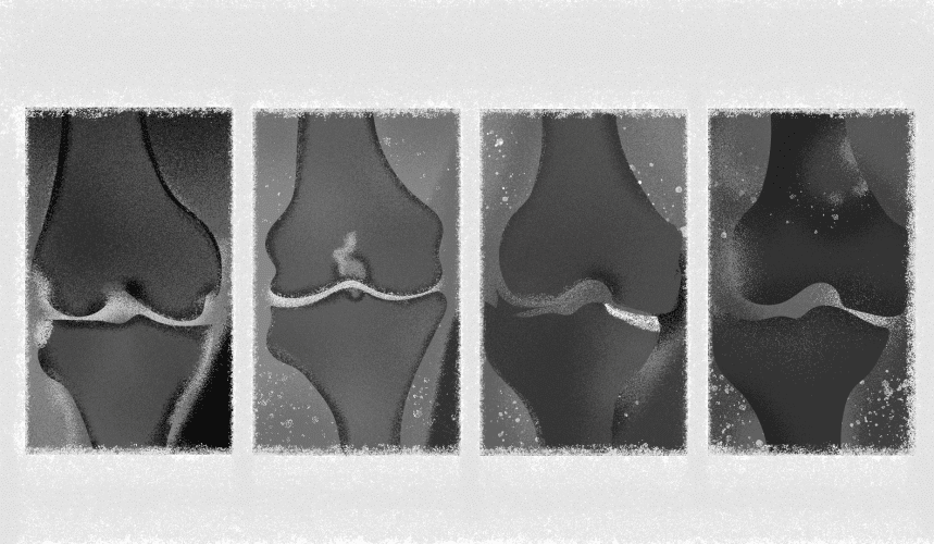 Knee Osteoarthritis The Foolproof Guide Top 8 Treatments