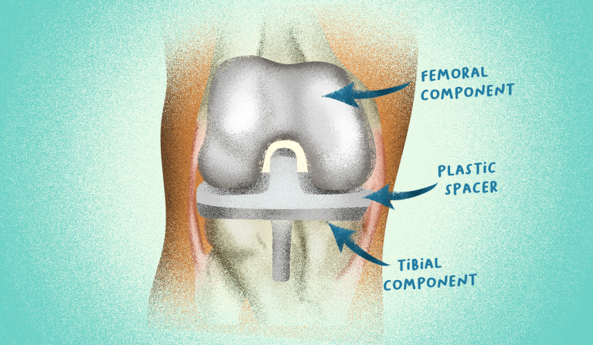 When Is Surgery Necessary For Osteoarthritis Of The Knee?