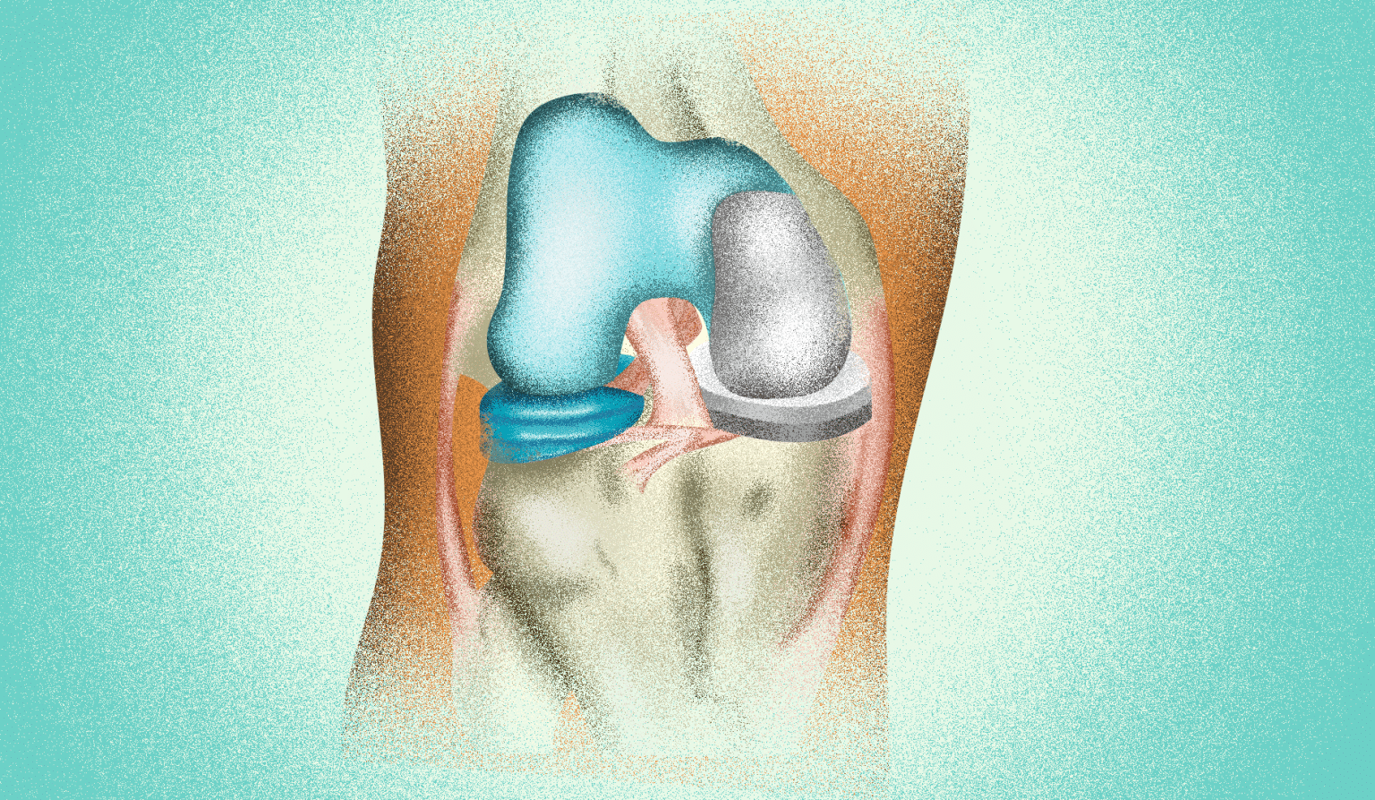 When Is Surgery Necessary For Osteoarthritis Of The Knee?