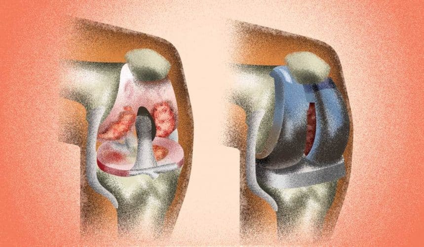 Knee Osteoarthritis The Foolproof Guide Top 8 Treatments